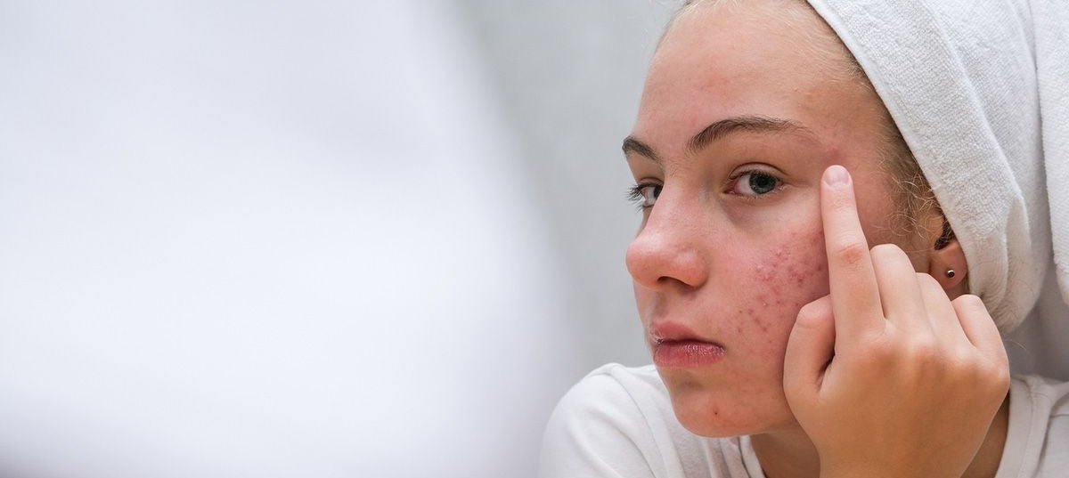 Effective Acne Removal Strategies for Clear Skin