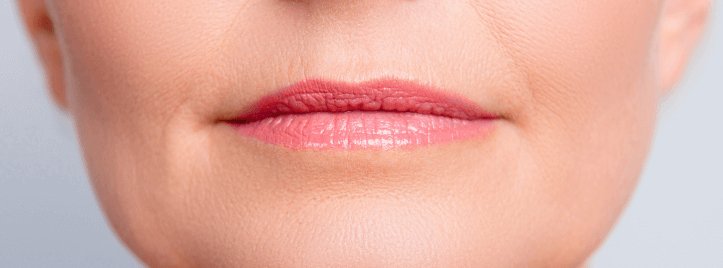 Eliminating Marionette Lines Without Exercise: Techniques That Work