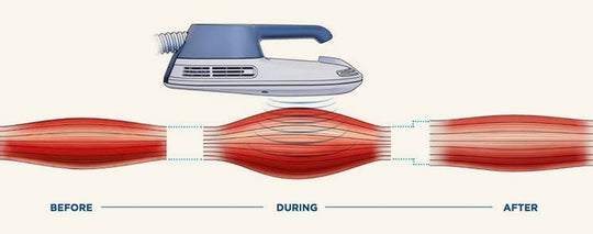 HIFEM Technology: The New Frontier in Fat Reduction and Muscle Buildin
