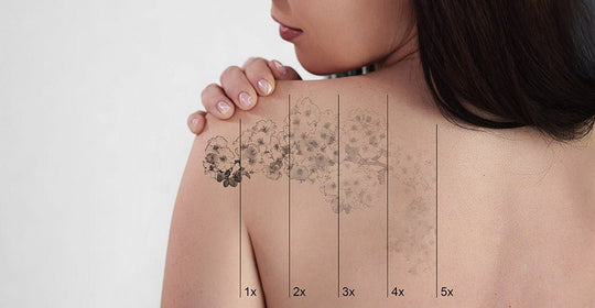 Laser Tattoo Removal: The Safe & Effective Way to Erase Unwanted Ink